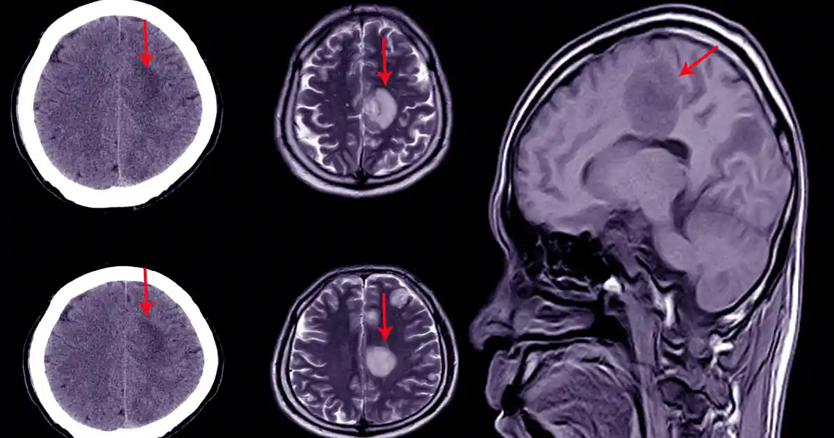 Anoxia vs. Hypoxia: Brain Injury Differences