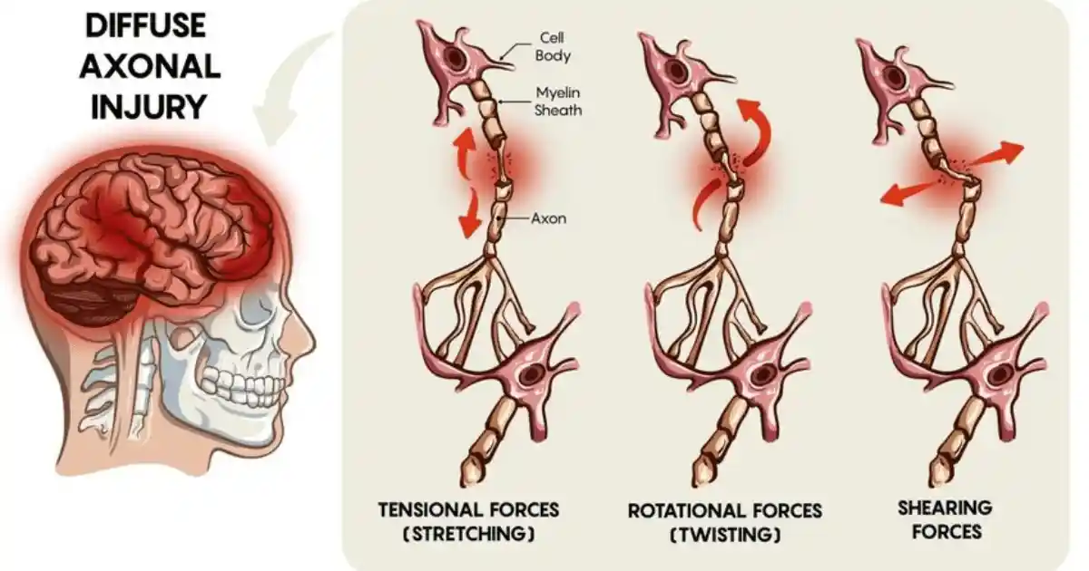 Diffuse Axonal Injury (DAI)? Understanding Causes, Symptoms & Legal Options